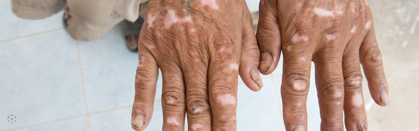 Scleroderma and Lupus - Kaleidoscope Fighting Lupus