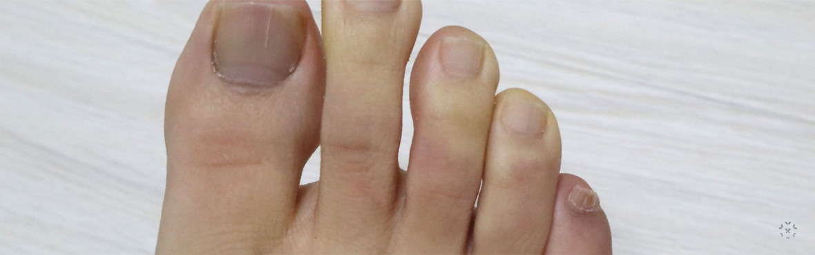 Scleroderma and Lupus - Kaleidoscope Fighting Lupus