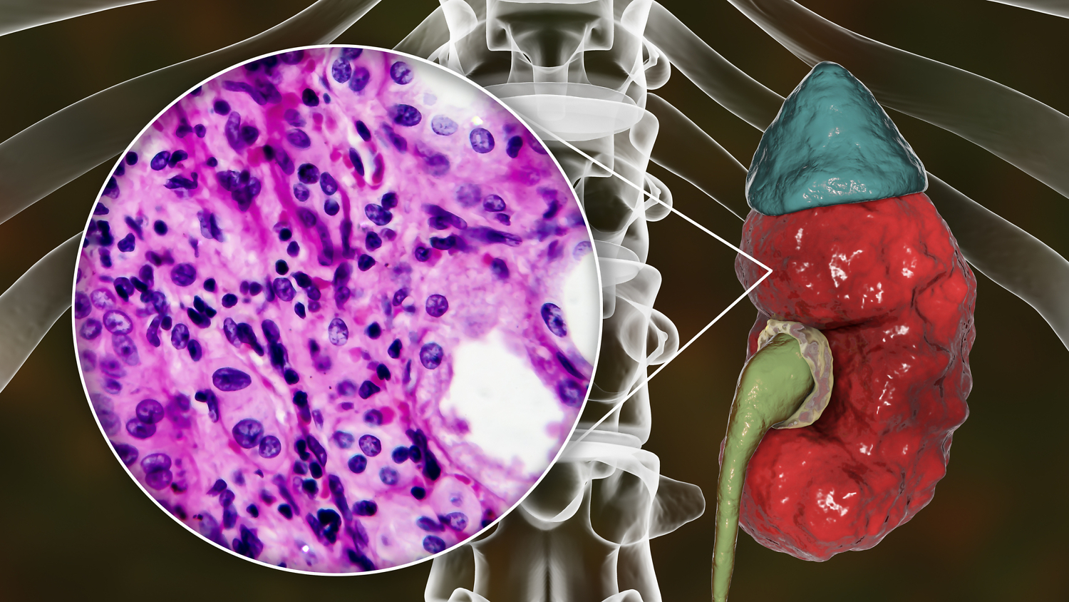 Lupus Nephritis - Kaleidoscope Fighting Lupus