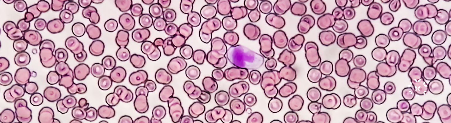 Lupus and Thrombocytopenia - Kaleidoscope Fighting Lupus